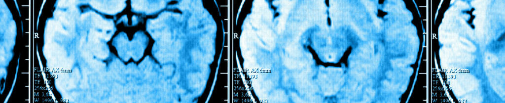 Brain Damage Caused by Drowning | Near Drowning Brain Damage